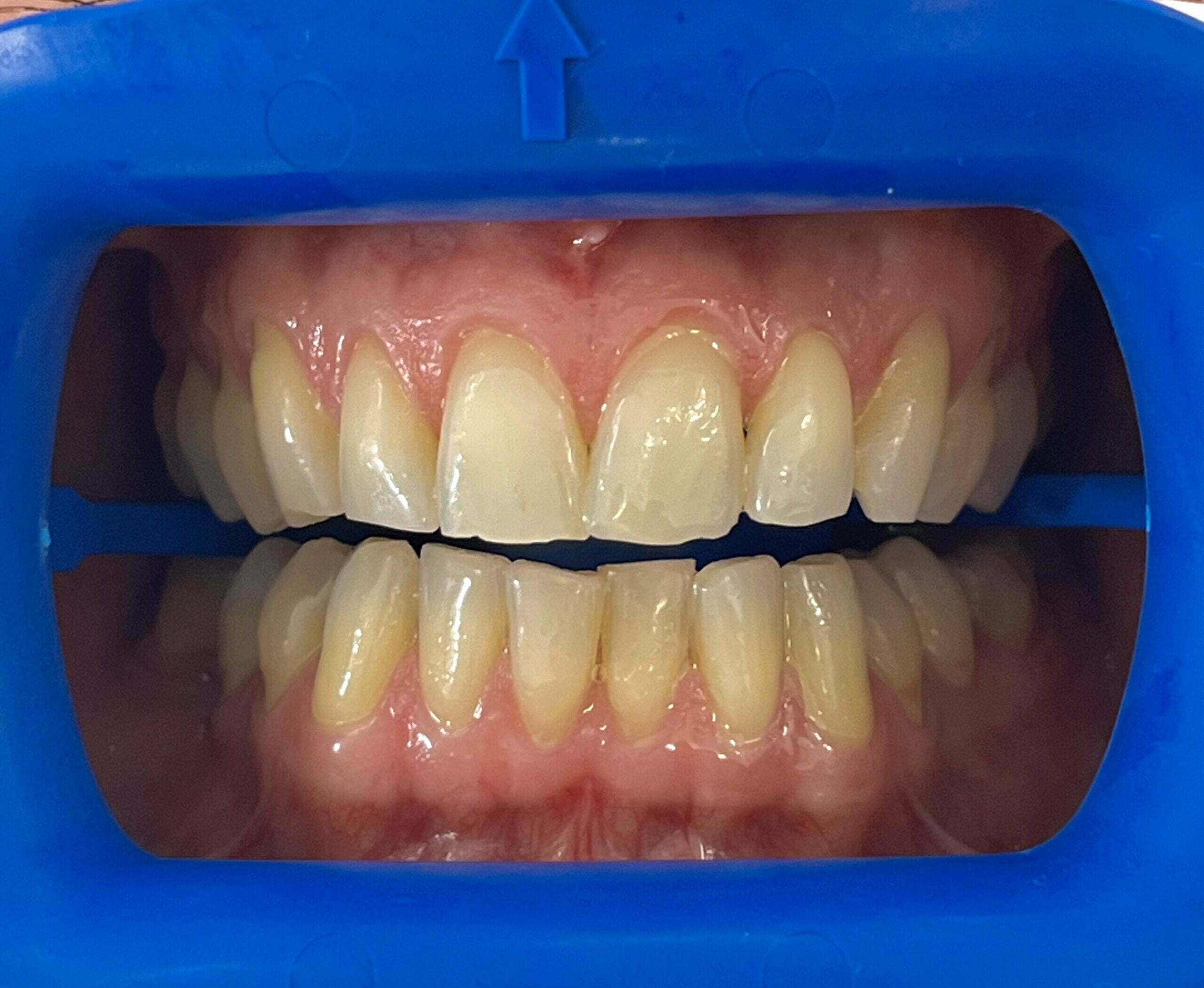 Before & After Smile Results | Aspired Smiles | Dentist In Laverton